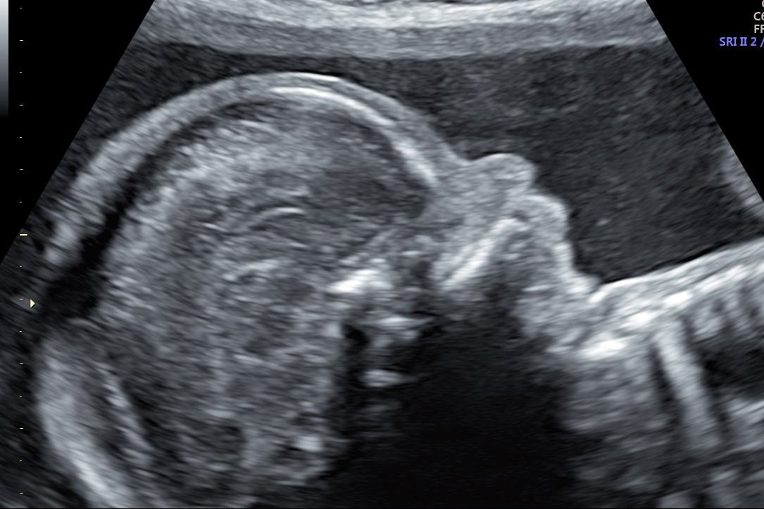 Nasal Bone Ultrasound 20 Weeks
